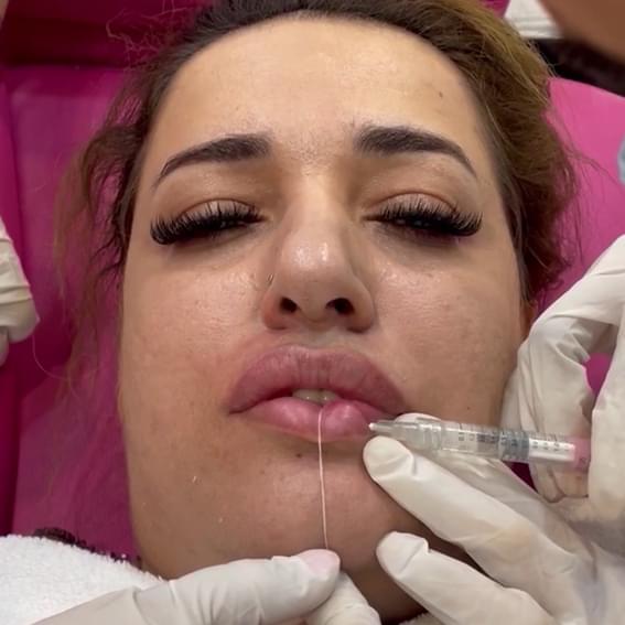 Dermal Filler Treatment in Delhi at Bella Soul Clinic